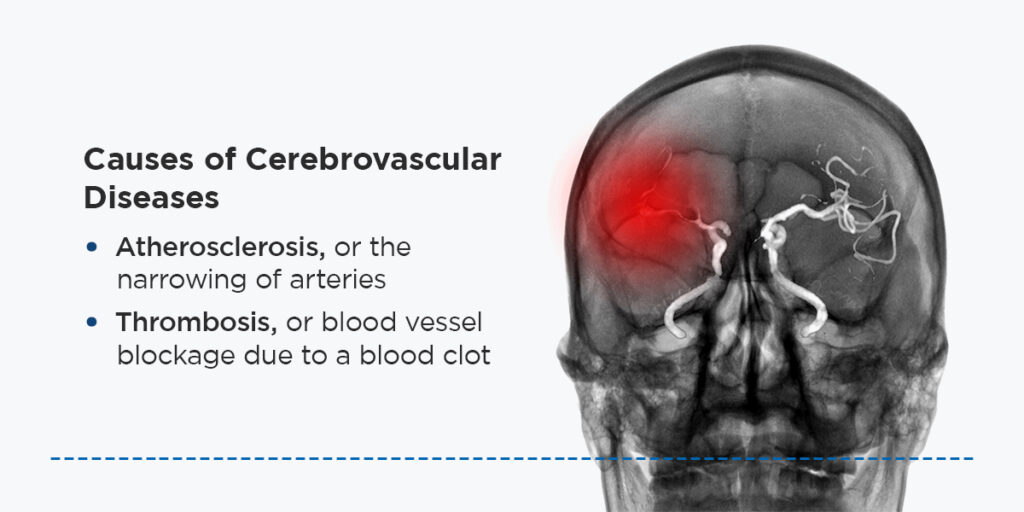 What Are Cerebrovascular Diseases Nysi